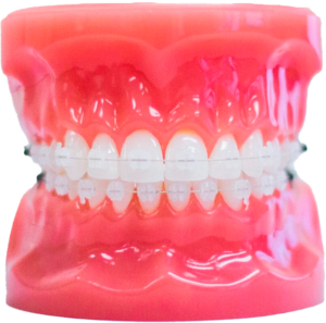 Clear Braces | Self-Ligating | Caudill & McNeight Orthodontics